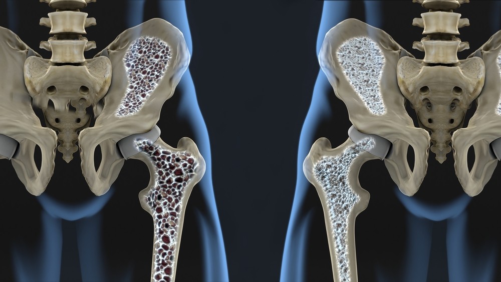 REMODELING OSSEO E OSTEOPOROSI – Scienze Salute e Benessere Hub